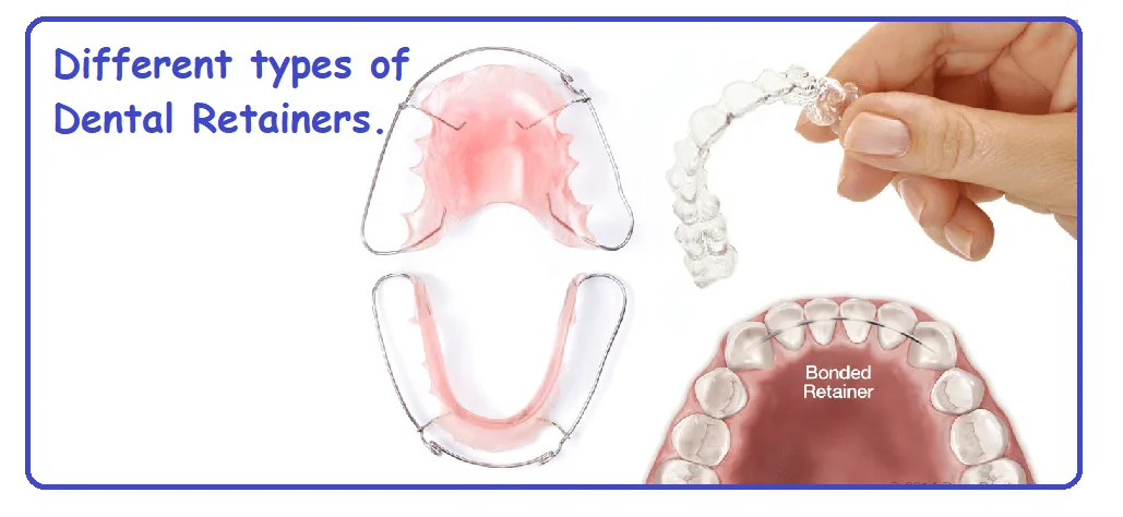 Orthodontic Retainer Top Teeth Retainer In Dubai | Al Hana Modern