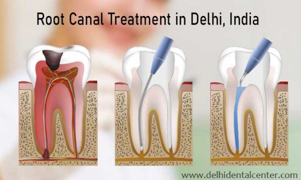 RCT Treatment in Greater Noida – Delhi Dental Center